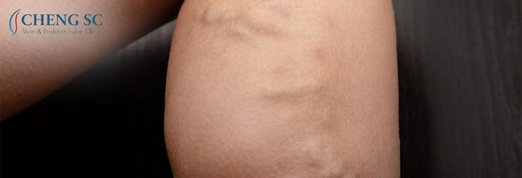 4 Signs You have a Serious Vein Problem | Cheng SC Veins and ...