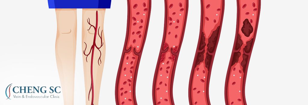 Problem Deep Dive: Deep Vein Thrombosis | Cheng SC Veins and ...